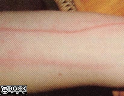 "Outcomes of Skin Prick testing"