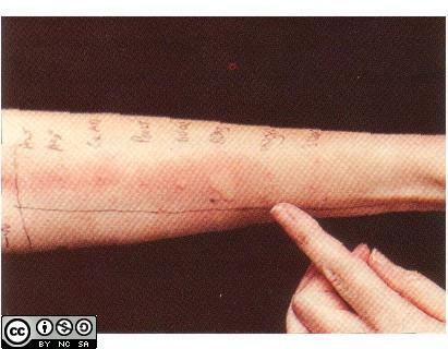 "Outcomes of Skin Prick testing"